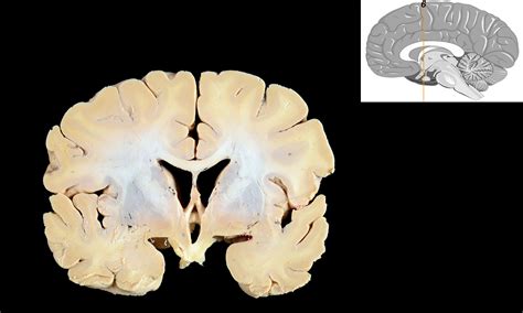 Corte Coronal 5 Eiatlas