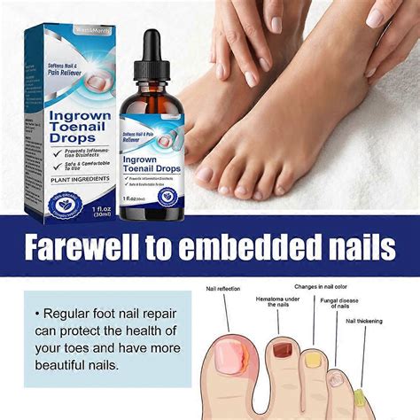 Ingrown Toenail Drops Ingrown Toenail Treatment Cuticle Care Oil For