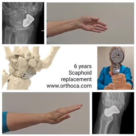 Frederik Verstreken On Linkedin Our First Patient With A 3d Printed