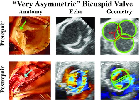 Pre And Postrepair Views Of Valve Anatomy Echocardiography Echo And Download Scientific