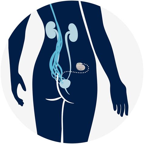 Advanced Therapies For Overactive Bladder Womens Pelvic Surgery