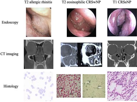 Frontiers Pathophysiological And Clinical Aspects Of Chronic Rhinosinusitis Current Concepts