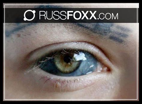 Scleral Staining Russ Foxx