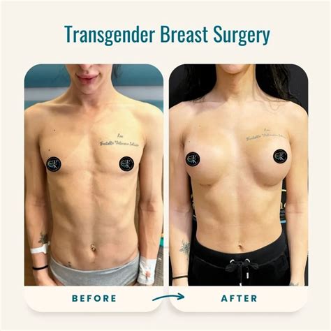 Transgender Breast Surgery Chest Feminization Steps Imed Medical