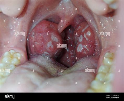 Tonsille Angina Tonsillite Malattia Batterica Prodotta Nelle