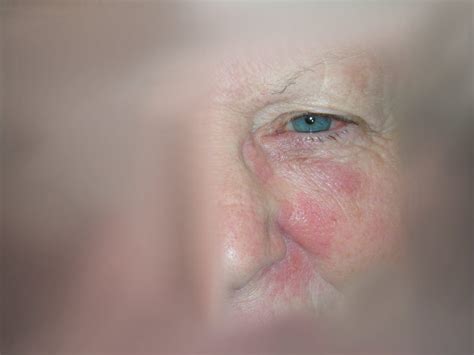 Maxillary Division Shingles A Diagnostic Conundrum Journal Of The Foundations Of Ophthalmology