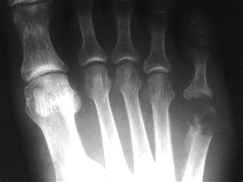 Osteomyelitis X Rays
