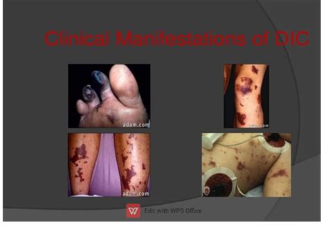 Coagulation Disorders Pdf