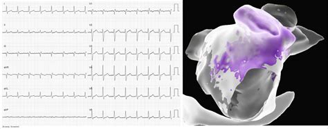 Iatrogenic Biatrial Flutter The Role Of The Bachmanns Bundle