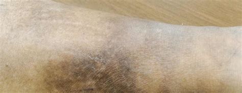 Cellulitis Johns Hopkins Medicine