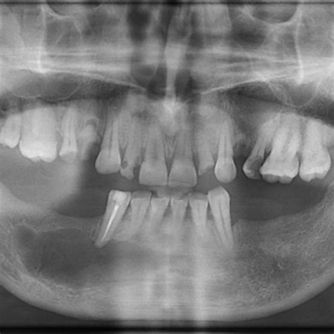 Cbct View Of The Ectopic Third Molar Download Scientific Diagram