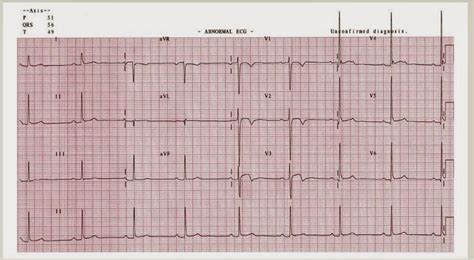 Persistent Juvenile T Wave Pattern Dr Smiths Ecg Blog