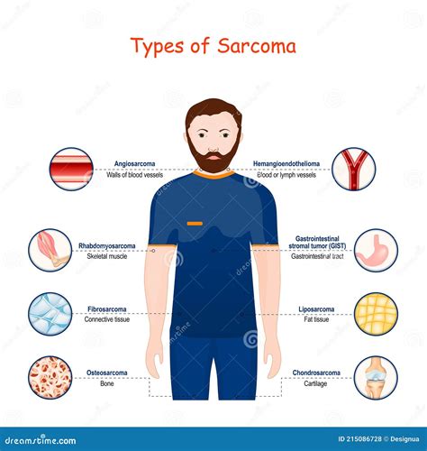 Sarcoma Types Of A Malignant Tumor Stock Vector Illustration Of