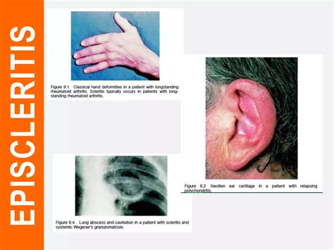 Episcleritis And Scleritis Pptx