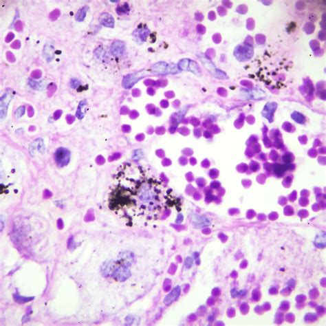 Pathology Reports Info From National Cancer Institute Paula Takacs Foundation