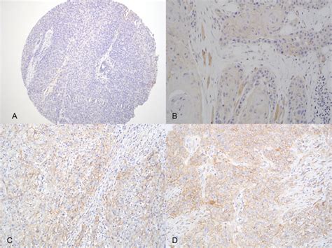 Association Of Pd L1 Expression In Oral Squamous Cell Carcinoma With