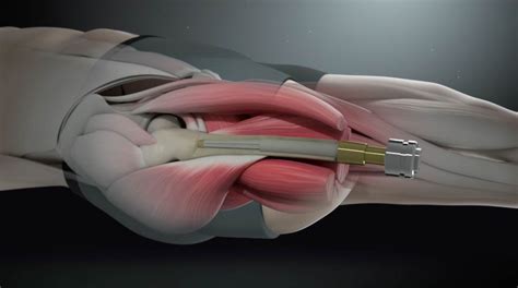 Osseointegration Faqs Osseointegration For Amputees