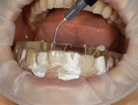 Injection Moulded Composite Veneers Optismile Advanced Dentistry And Implant Centre