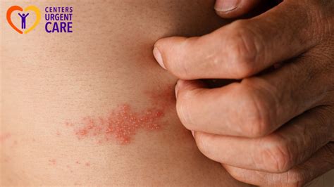 Wellness Tips From Josef Schenker Md Treating Shingles Centers
