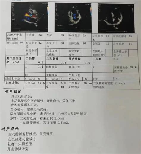 经典病例周周谈｜佛山映月心血管介入论坛 ——一例纯反流病例分享 严道医声网