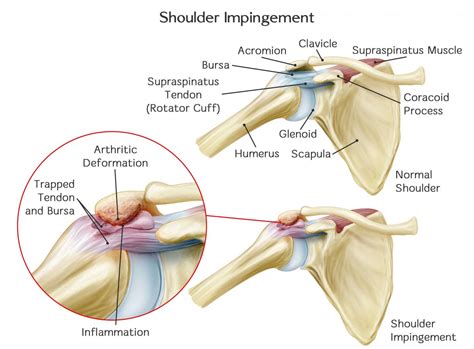 Subacromial Impingement Dr Raymond Yu
