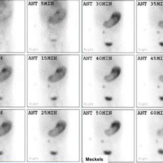 Pdf The Meckels Scan A Report From 18 Years Practice