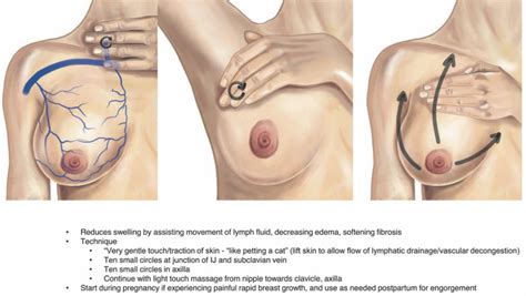 New Mastitis Protocols From Academy Of Breastfeeding Medicine R