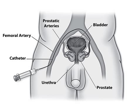 Prostatic Artery Embolization Pae