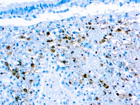 Diagnostic Biosystems Herpes Simplex Virus Ii Hsv Ii Herpes Simplex