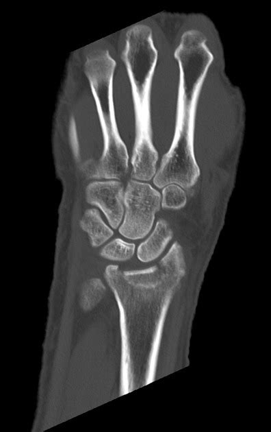 Die Punch Fracture Distal Radius Fractures Knowledge Amboss