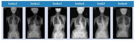 Lenke Classification Report Generation Method For Scoliosis Based On