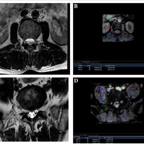 The Cauda Equina Mri T2w Image A And Its Fa Mapping Of Dti B Rois Download Scientific