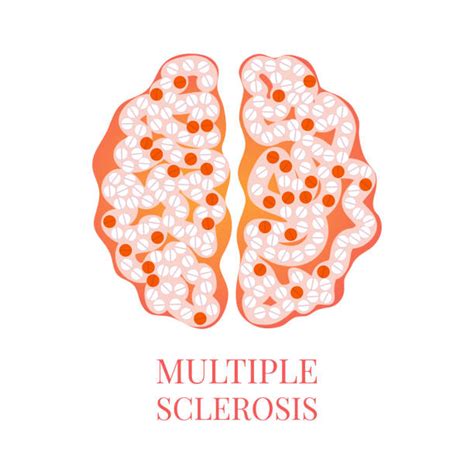 Multiple Sclerosis Illustrations Royalty Free Vector Graphics And Clip Art Istock