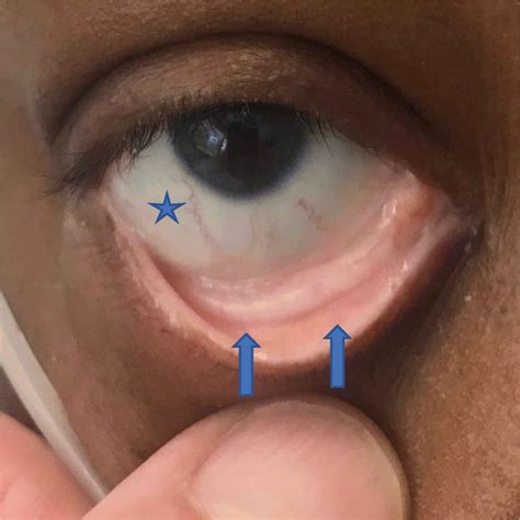 Conjunctival And Palmar Pallor Pmc