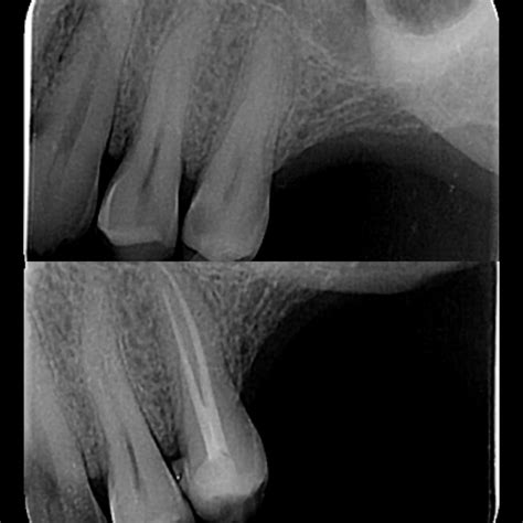 Predrag Živkov On Linkedin Dg Necrosis Pulpae Dentis Terapija Urađena