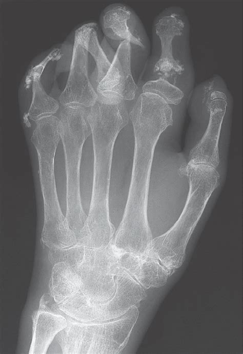 39 Collagenoses Radiology Key