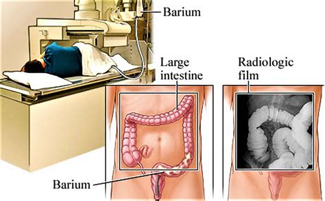 Barium Enema Procedure Prep Side Effects Barium Enema Vs Colonoscopy