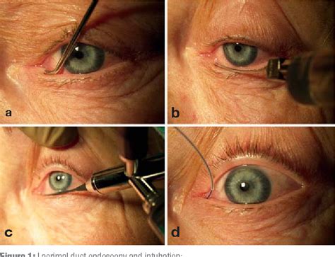 Tear Duct Anatomy Eyelid Anatomy Eye Dilation