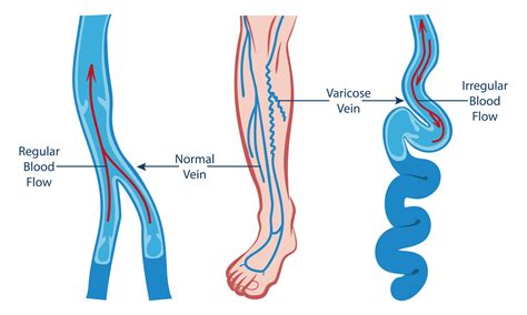 Phlebitis Lumino Cielo