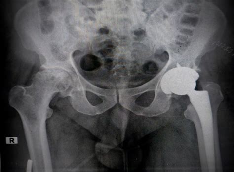 Dr Vikram G K Bhat On Linkedin Are You Okay With A Low Offset Femur Stem Or Do You Prefer A