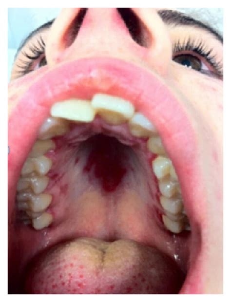 Lupus Mouth Sores Associated With Systemic Lupus Erythematosus