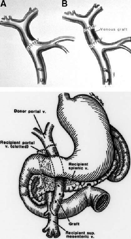 Portal Vein Anastomosis A End To End B Segmental Interposition