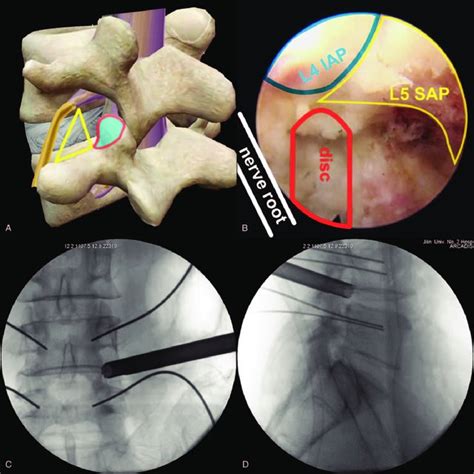 Nerve Root Decompression Was Conducted Under Endoscopic The Red Arrow Download Scientific