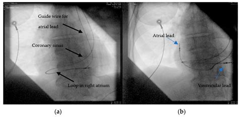 Coronary Sinus Lead