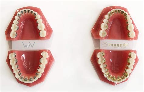 No 1 Lingual Braces Voted Best Dental Practice In Uk