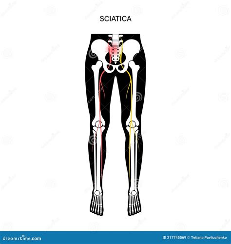 Muscular Pelvis Sciatica Stock Vector Illustration Of Bulging 217745569