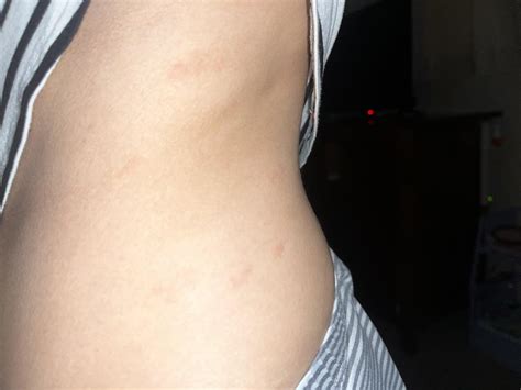 Pityriasis Rosea On Face For 6 Months Rpityriasisrosea