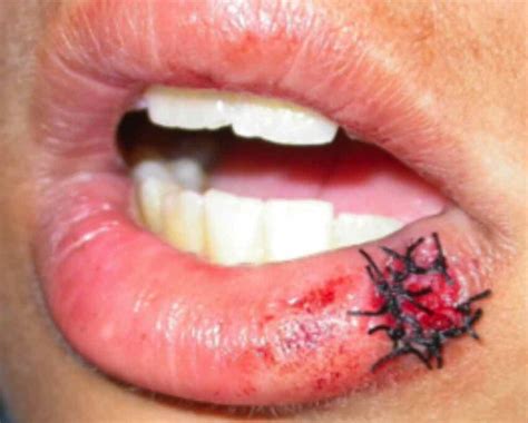 Postoperative View Immediately After Excision Of The Lesion Download