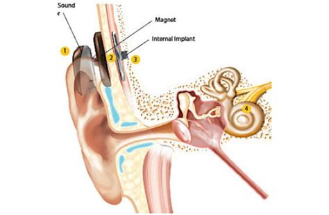 Bone Conduction Hearing Devices Dr Manasas Specialty Ent Centre