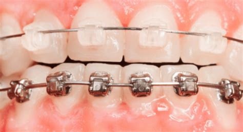 Tads Advanced Masterclass Managing Complex Malocclusions Using Tads